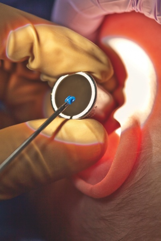 Indianapolis Doctors Urge Discretion When Placing Ear Tubes in Children ...