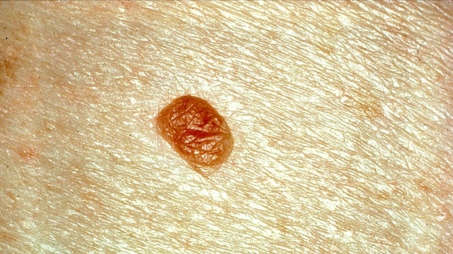 When to Call the Doctor About a Skin Mole | Angie's List When to Call the Doctor About a Skin Mole | Angie's List